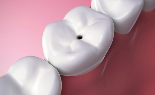 Understand Tooth Decay and Dental Fillings | Affordable Dentist Maryland