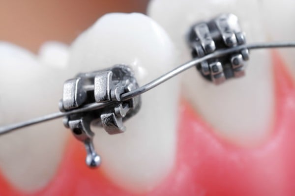 The History of Braces